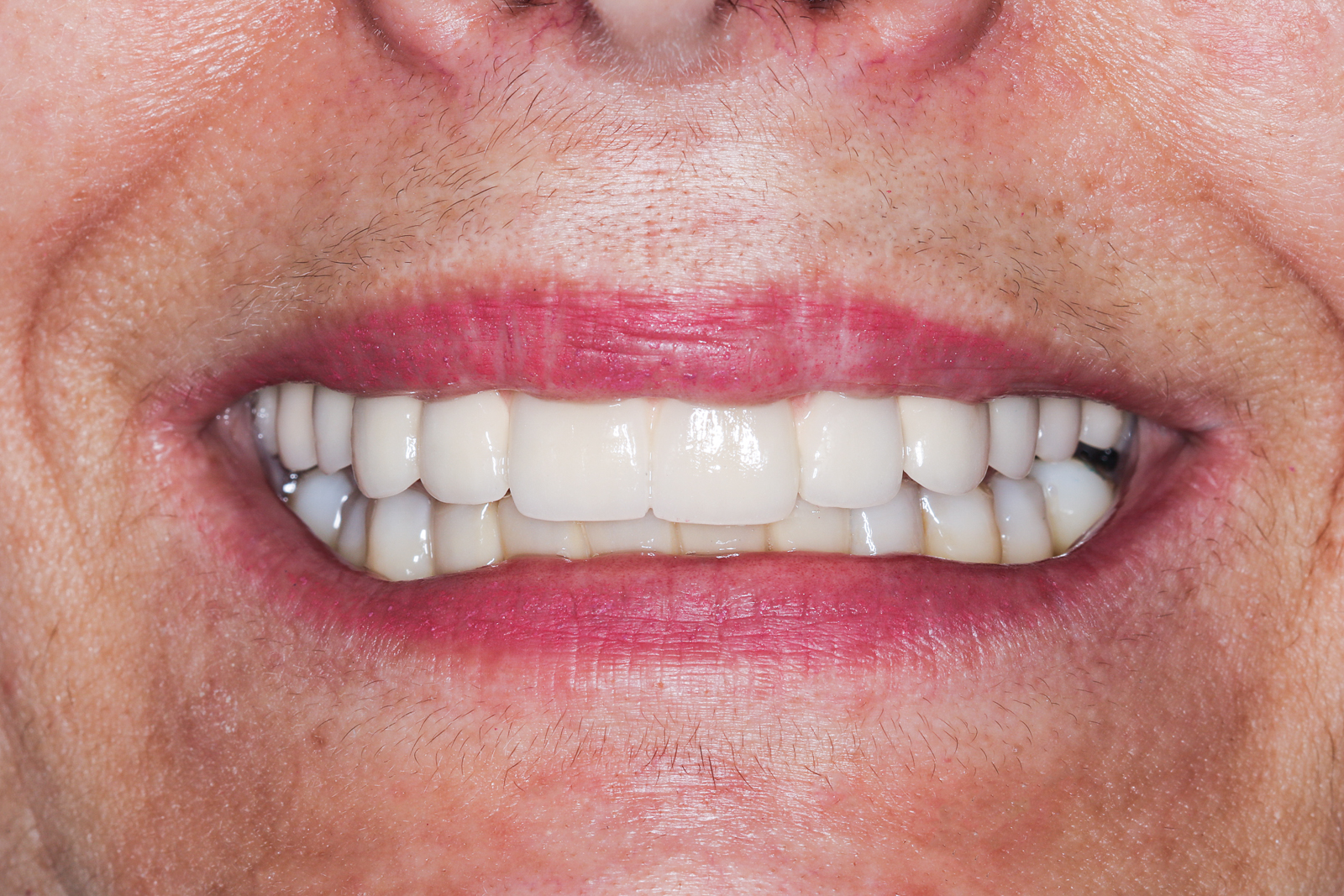 Prothèse fixe - Tourisme dentaire