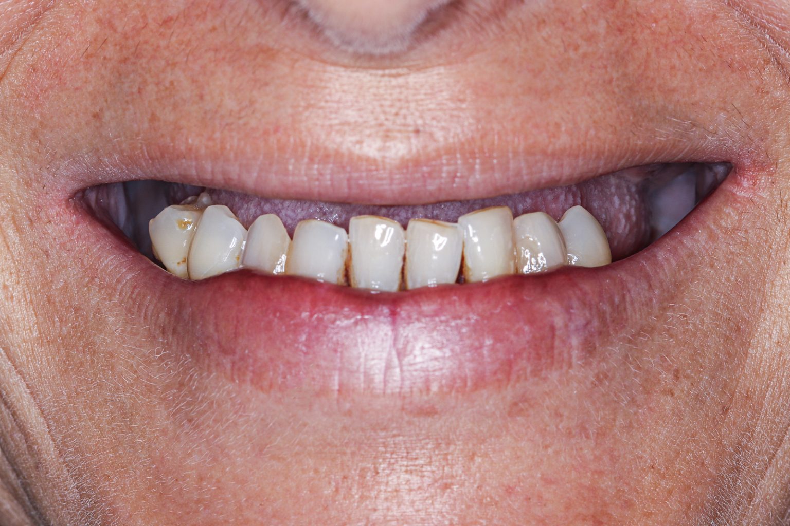 Prothèse fixe - Tourisme dentaire