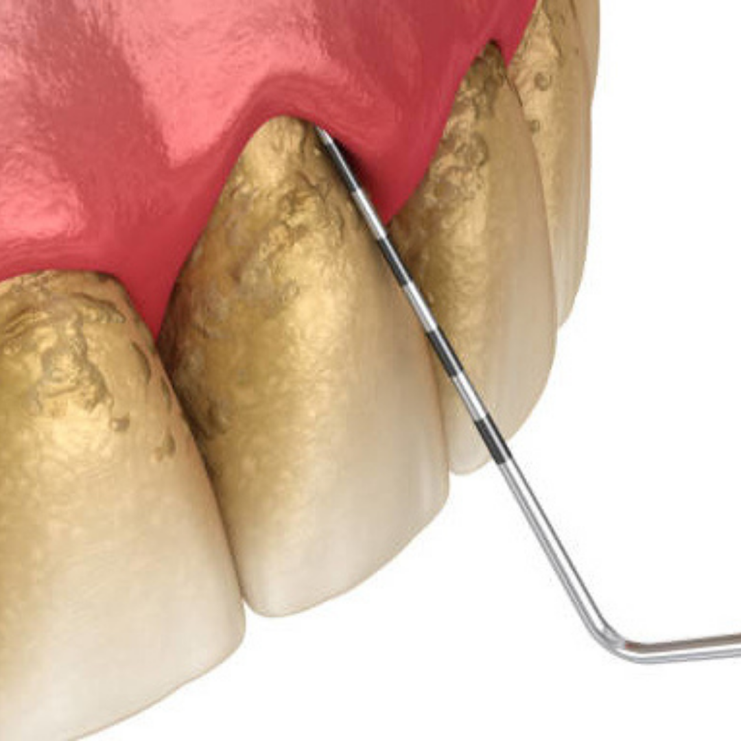 Gingivite - Tourisme dentaire